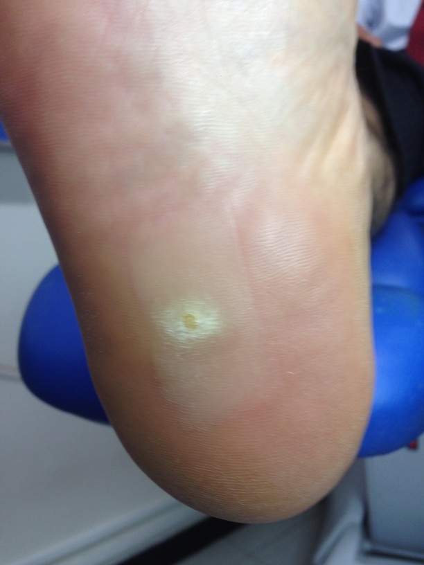 Papiloma podologos en bogota - Podólogo Bogotá, podologo bogota ...